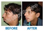 Best Chin Augmentation Surgery Delhi Chin Implant Cost India