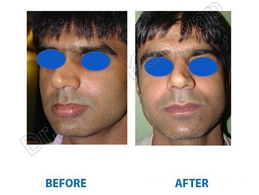 Lip Reconstruction Before And After